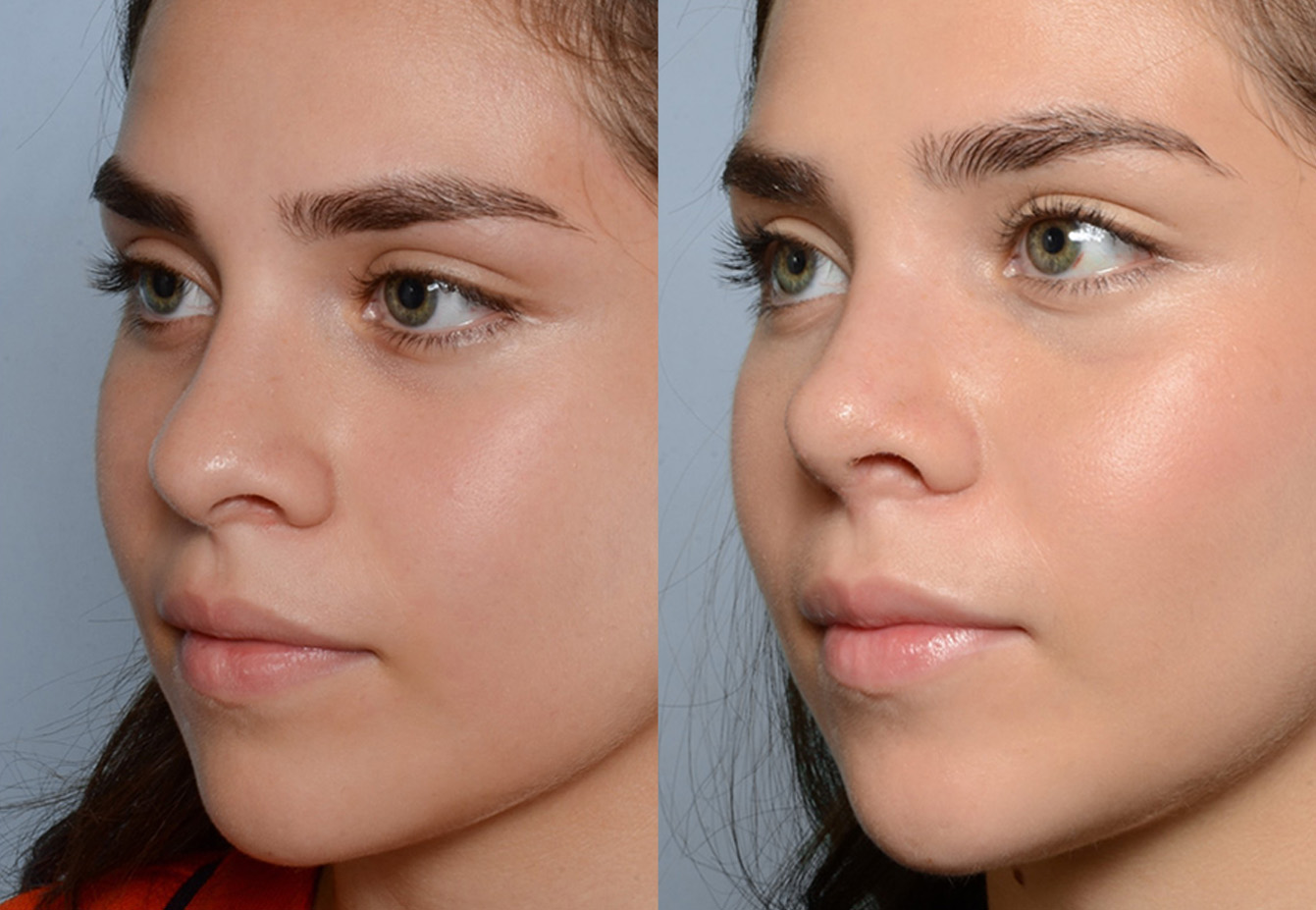 Rinoplastía Paciente 20 - Dr. Raúl López